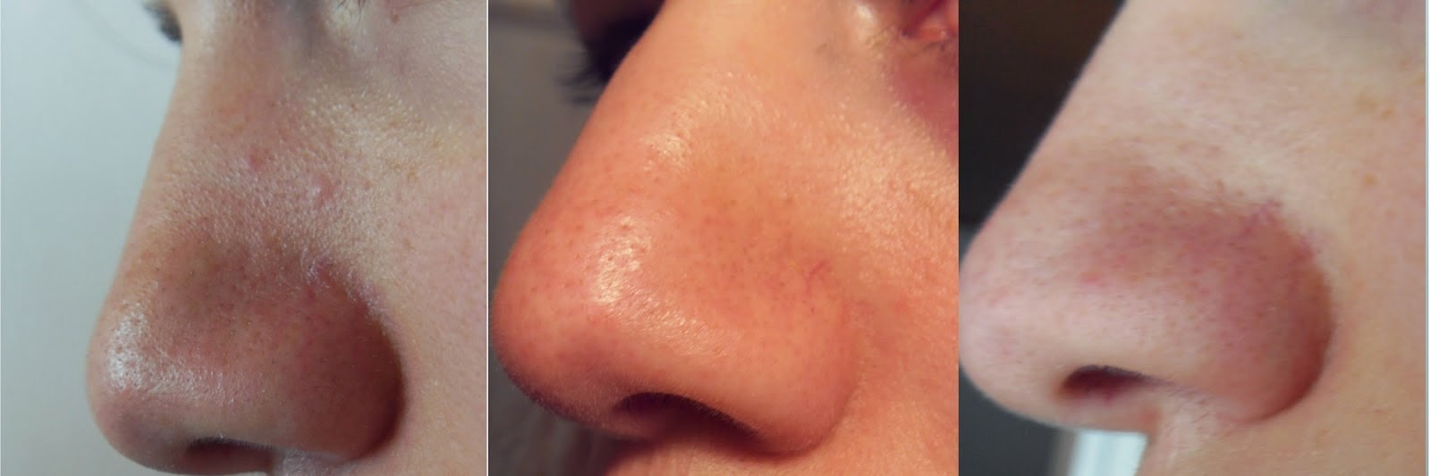 Beauté Bio: Points noirs ou filaments sébacés