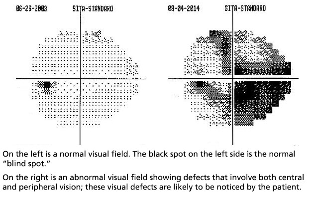 Eye Surgeon Blog: What Is Visual Field Testing?