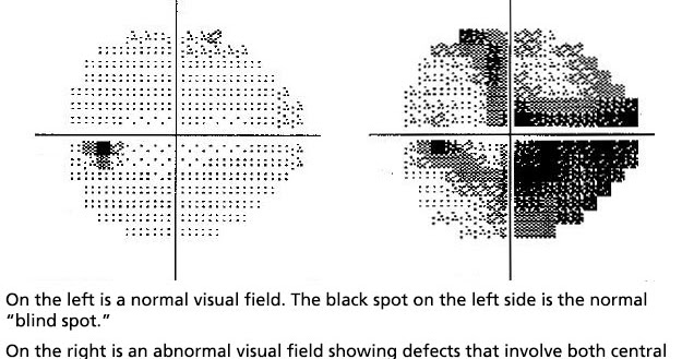 Eye Surgeon Blog: What Is Visual Field Testing?