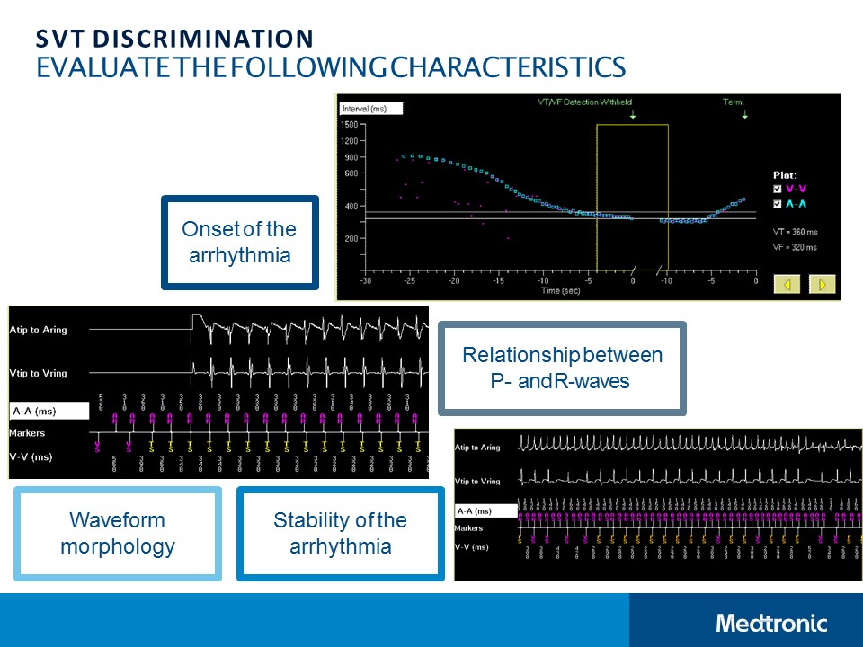 CVT Mohd Farid: Concept Of ICD Technology-SVT Discrimination Algorithms ...