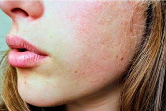 How To Treat Seborrheic Dermatitis On Your Face - Tashiara