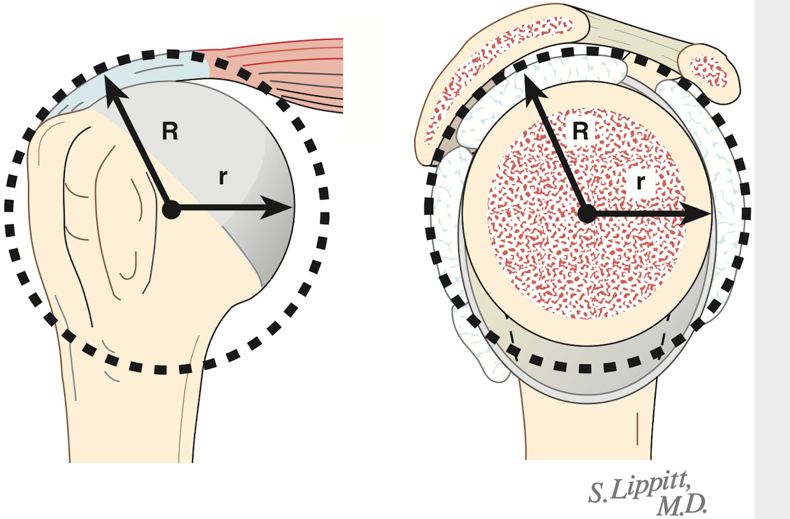 UW Shoulder and Elbow Academy: Don't cut the coracoacromial ligament ...