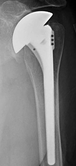 Short-stem humeral components, an advantage?