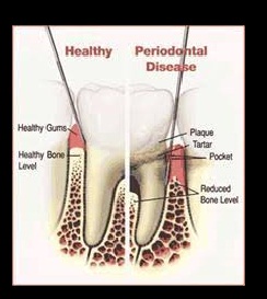 Cancer and erectile disorder
