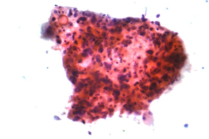 Science And Life Lung Cancer Science And Life Lung Cancer