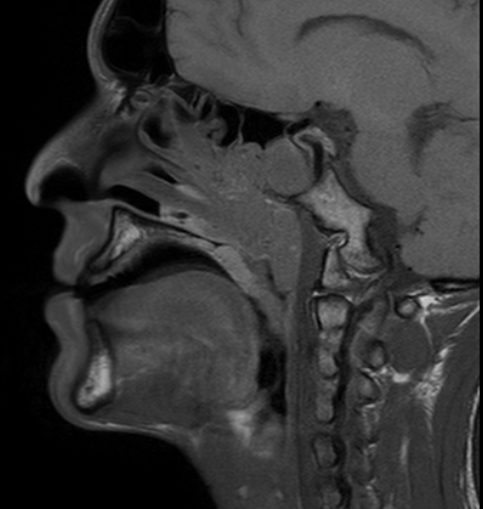 Nasopharyngeal Angiofibroma-MRI - Sumer's Radiology Blog