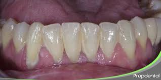 Comienzos de una higienista: Tipos de cálculos dentales: El cálculo ...