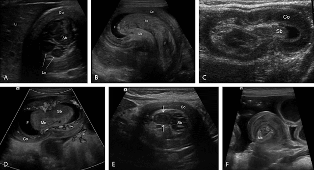 MEDICAL ULTRASOUND/ INTUSSUSCEPTION