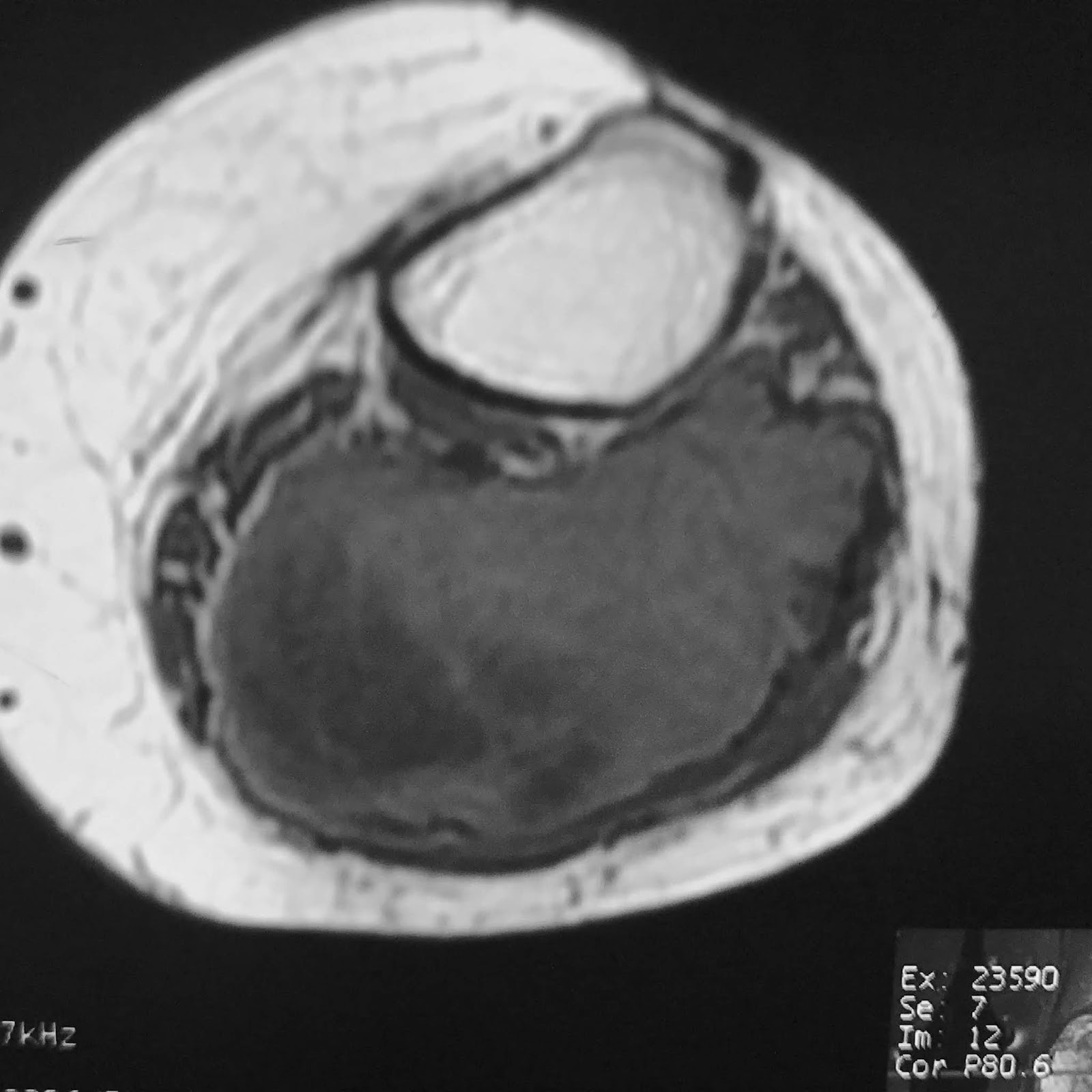 VIETNAMESE MEDIC ULTRASOUND: CASE 523: FIBULAR BONE TUMOR, Dr PHAN ...
