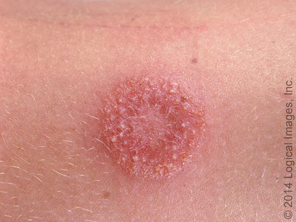 EL RINCÓN DE LA MEDICINA INTERNA. juanpedromacaluso@yahoo.com.ar: TIÑA ...