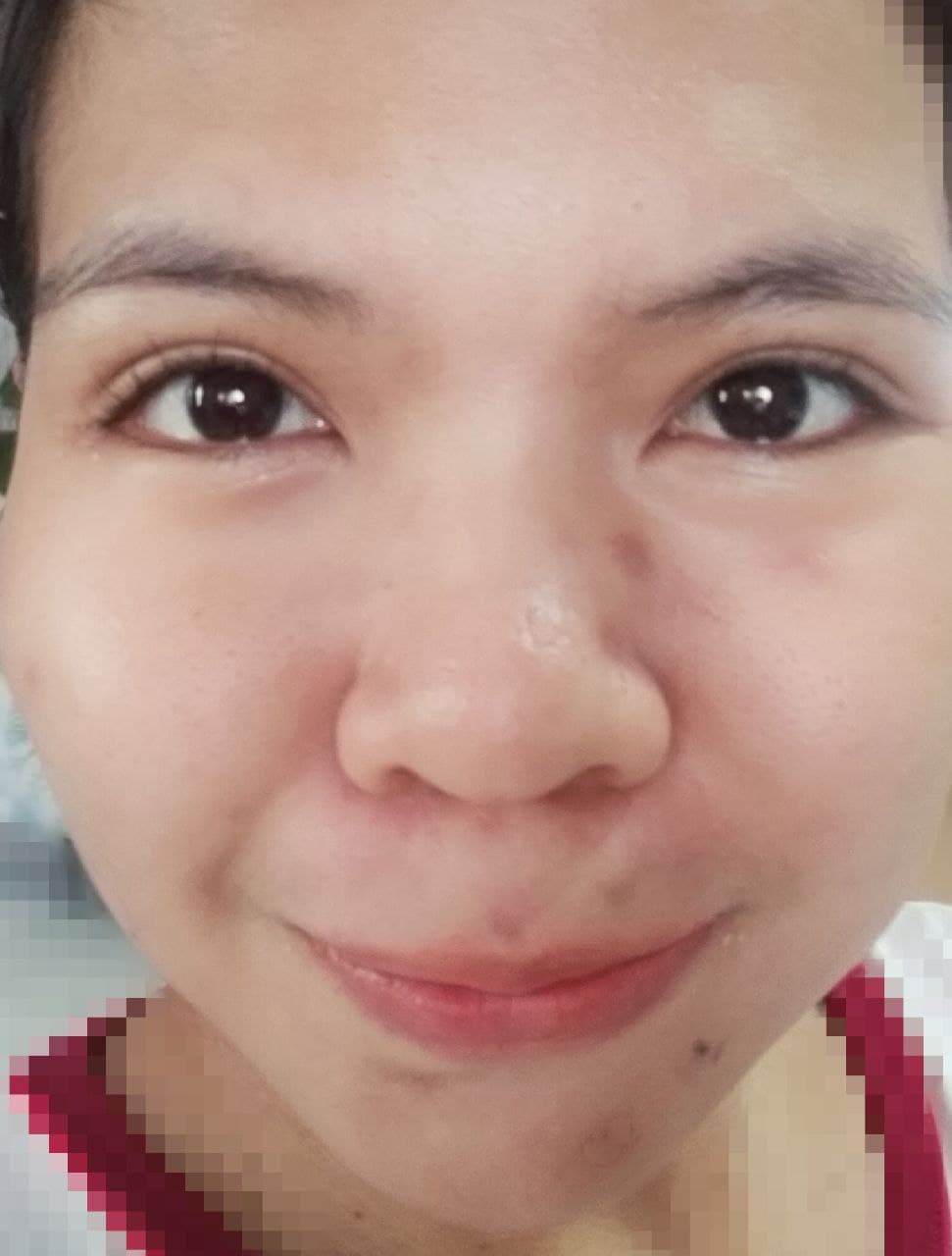 Bagaimana Cara Nak Atasi Kulit Breakout Teruk Akibat Salah Guna Produk? ~ Sina Shaari