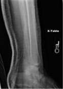 Case of the Month: Fracture cases at Harborview Medical Center ...