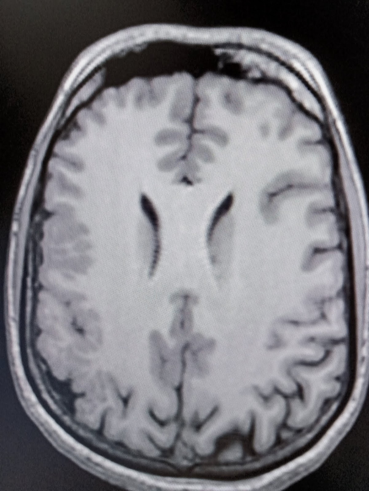 Polymicrogyria : MRI Teaching Case - Sumer's Radiology Blog