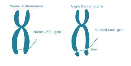 Fragile X syndrome (FXS)