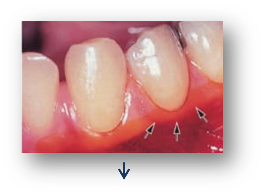 UNIDAD III: Encía Periodontológica