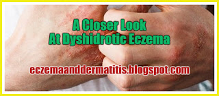 A Closer Look At Dyshidrotic Eczema - Eczema and Dermatitis