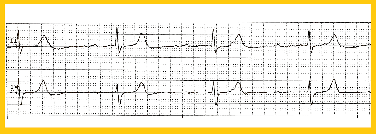 ACLS review: Bradycardia Review Questions Part 2