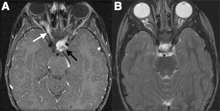 MRI Differential Diagnosis: Optic nerve enhancement