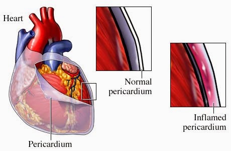 Pericardite Tratamento - As Doenças Cardíacas