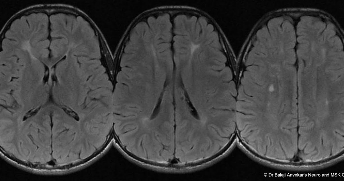 Dr Balaji Anvekar FRCR: Ears of the lynx sign MRI Brain