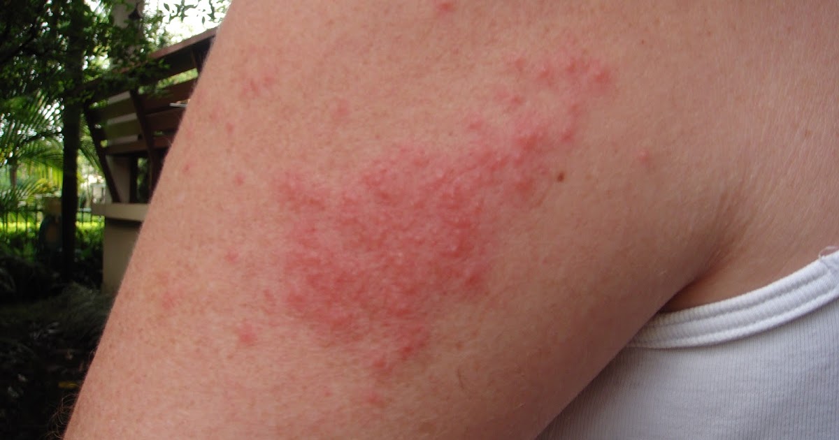 my story about multiple myeloma: Uitslag door een verzwakt immuunsysteem