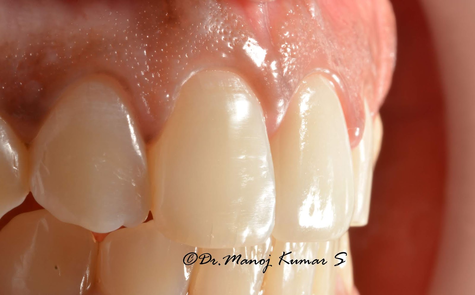 Case 2: E-max Crown in 2.1- Esthetics mimicked