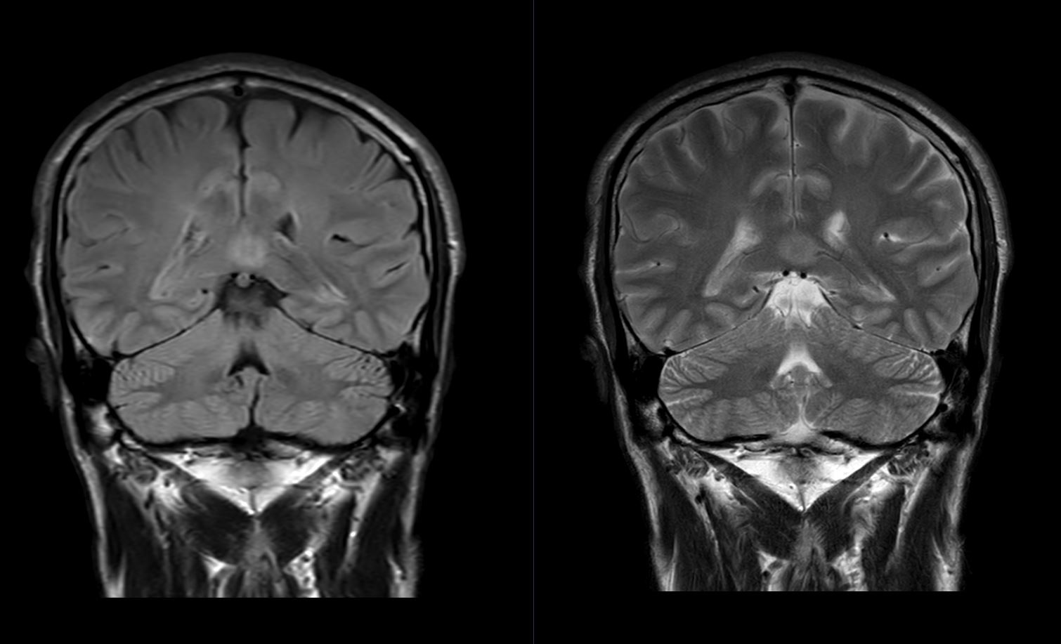 Cytotoxic Lesions Of the Corpus Callosum (CLOCCs)