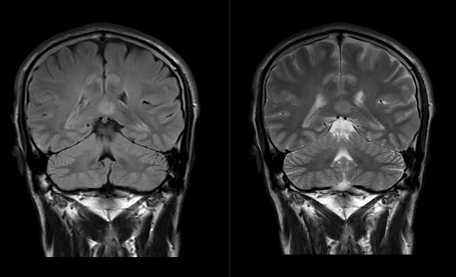 Cytotoxic Lesions Of the Corpus Callosum (CLOCCs)