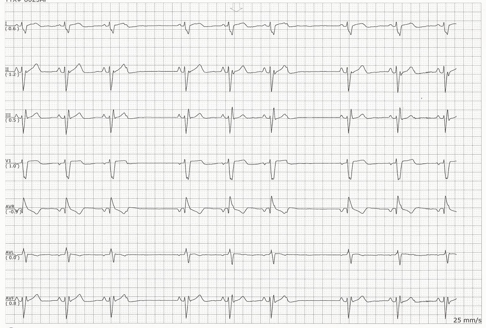 Sinus rhythm with dropped PACs