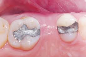 amalgama dental: amalgama dental