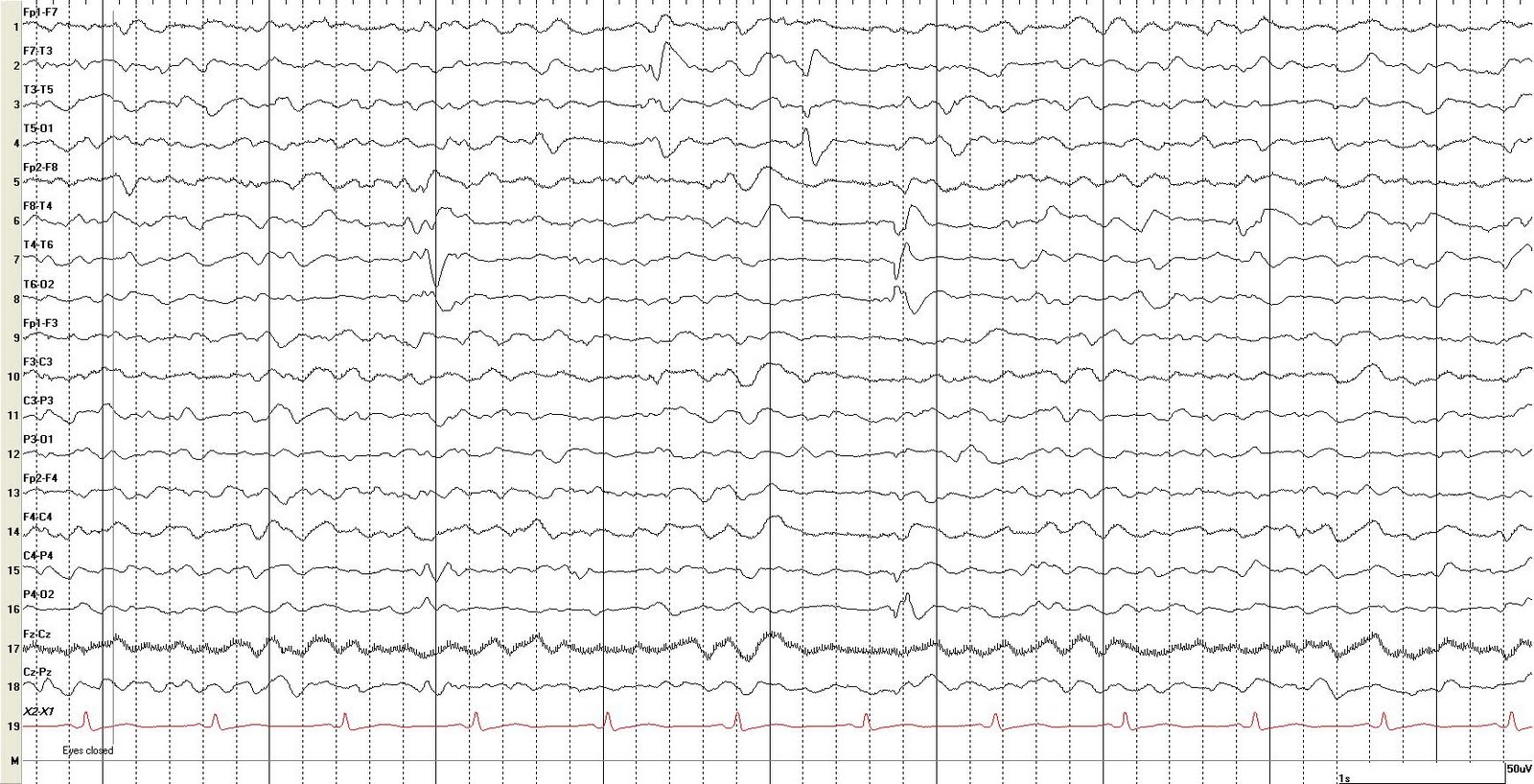 EEG Reviewer: EEG No. 31