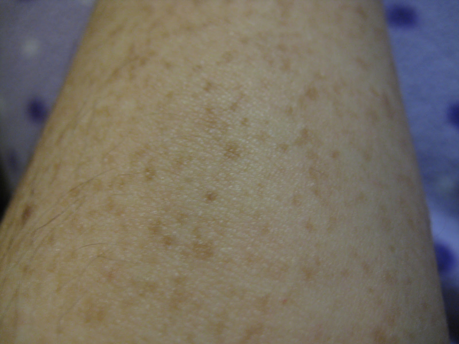 NF's effect on me, including freckling and outer fibromas
