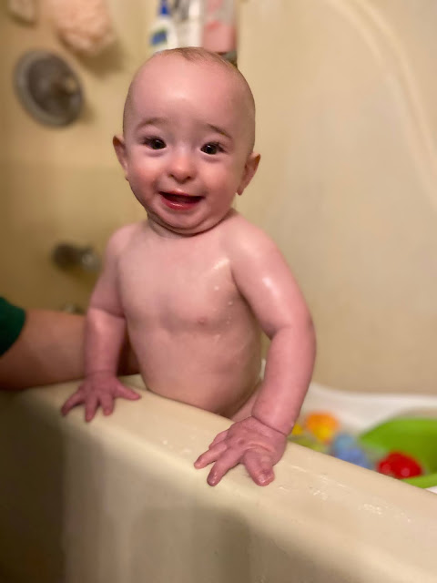 Syndactyly as part of a syndrome | Congenital Hand and Arm Differences ...