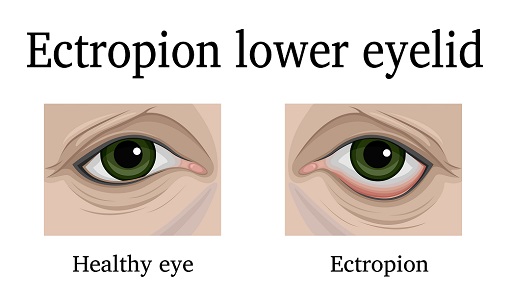 Ectropion : Causes, Symptoms & Complications