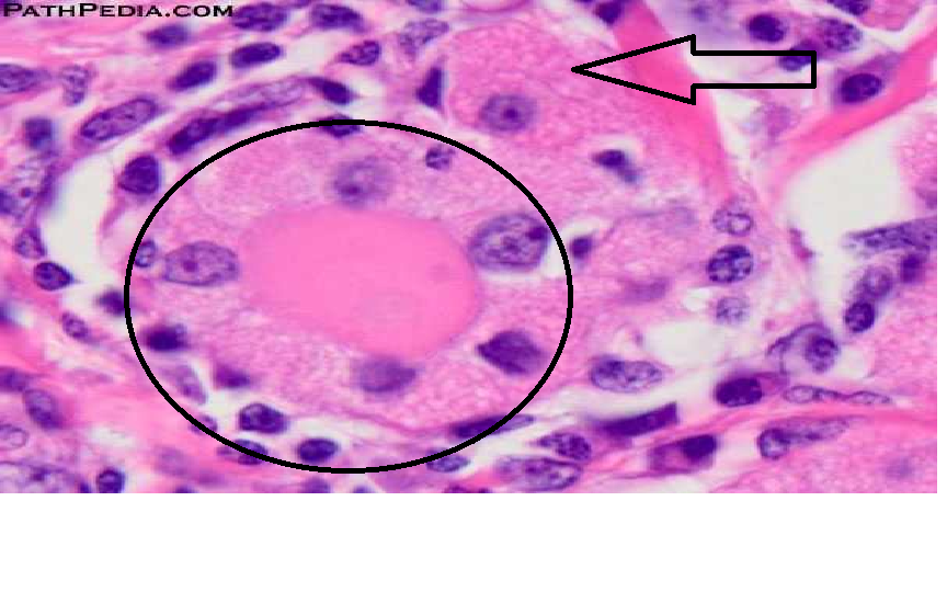 Pathology Cases: Block 2 Case 1 - immuno