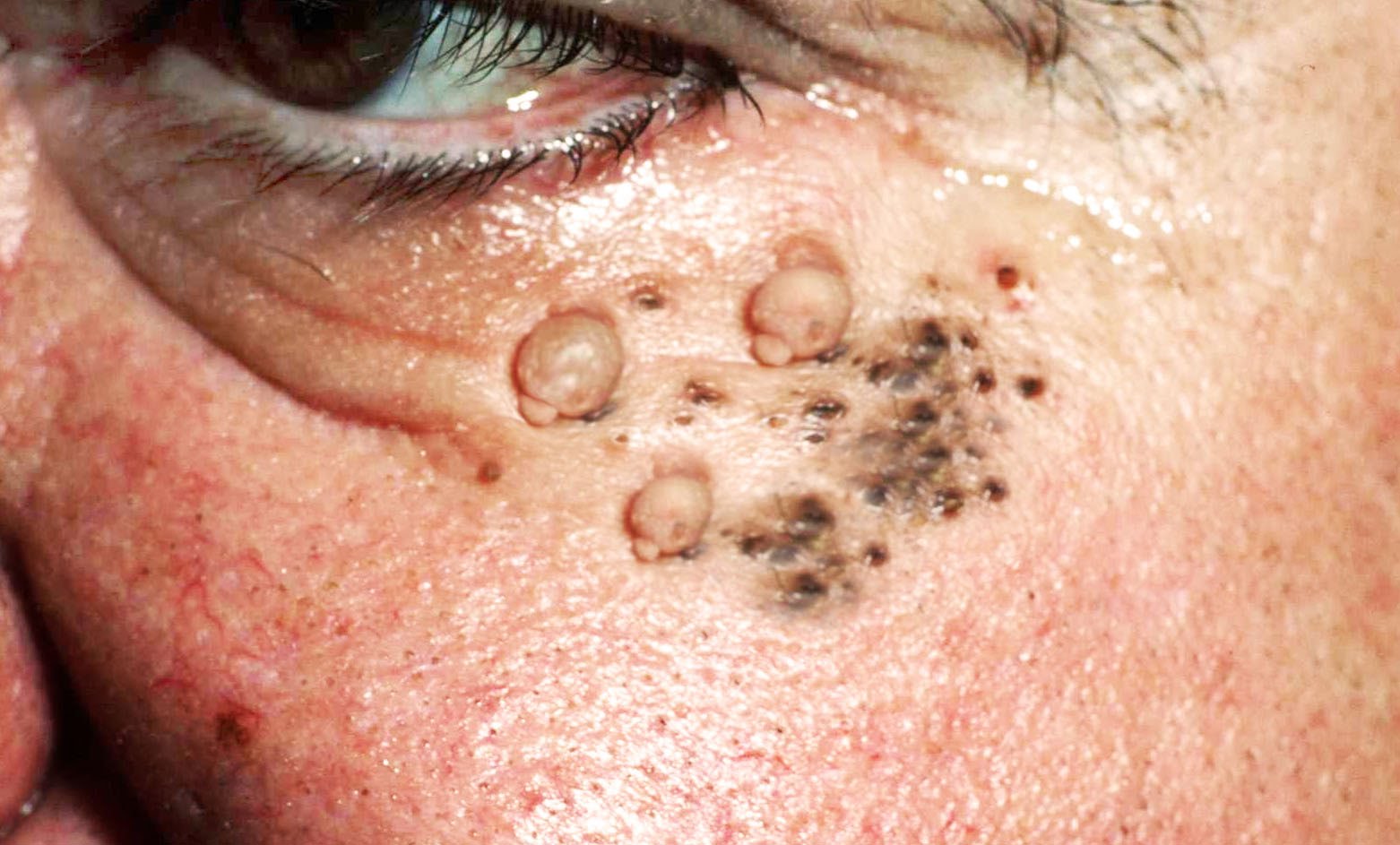 Extracting Blackheads