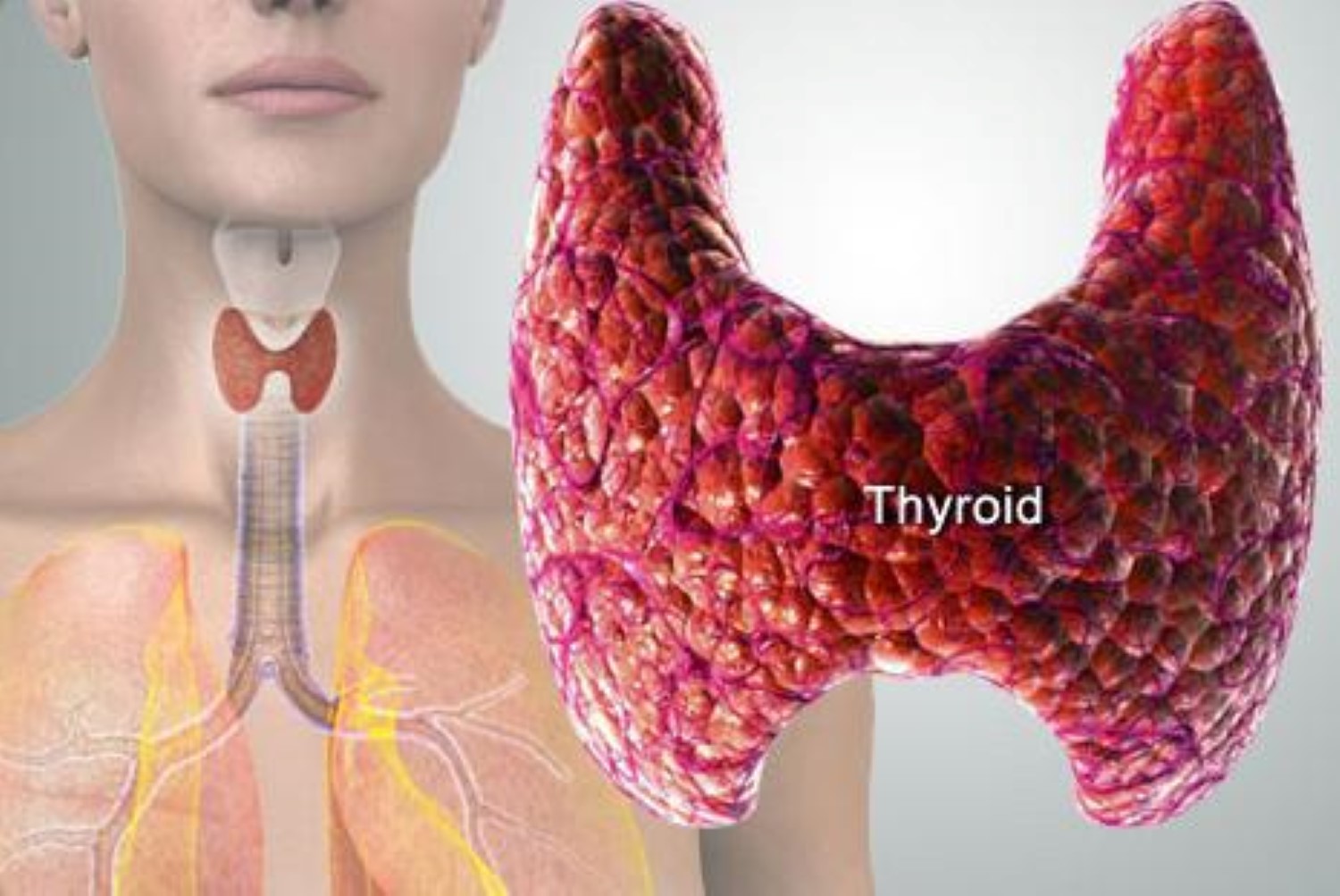 RAWATAN PENYAKIT TIROID YANG BERKESAN - CUTE AND BEAUTY