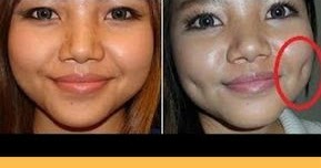 Ways To Get Dimples Naturally On Your Cheeks - TOP 5 DIY