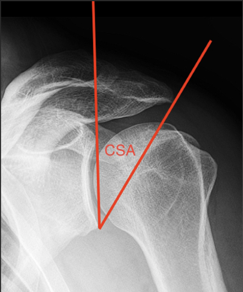UW Shoulder and Elbow Academy: The critical shoulder angle: what does ...