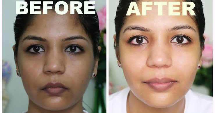 Skin Bleaching About Bleach Creams And Side Effects Healthview