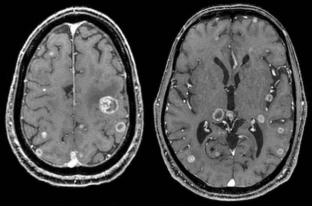 Radshare: CEREBRAL METASTASIS- MULTIPLE RING ENHANCING LESIONS
