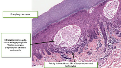 Dermatopathology Made Simple - Inflammatory: Vesicles or Blisters