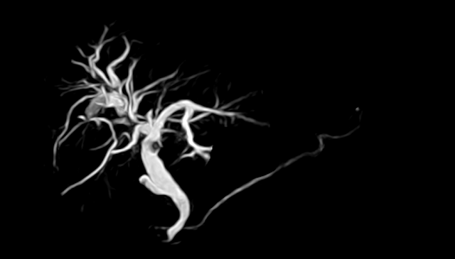 ColangioResonancia Normal y Variantes