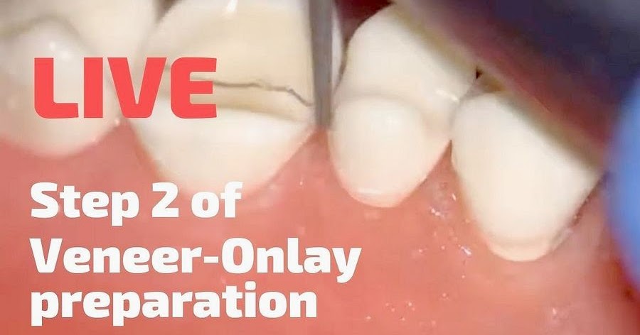 TOOTH PREPARATION: Veneer-Onlay preparation - Odonto-Tv