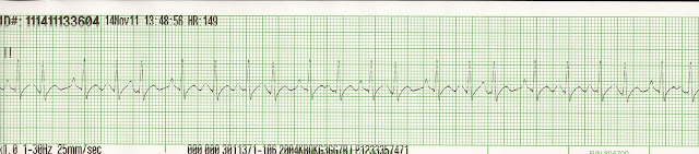 EKG Rhythm Strips 21: Fast rhythms
