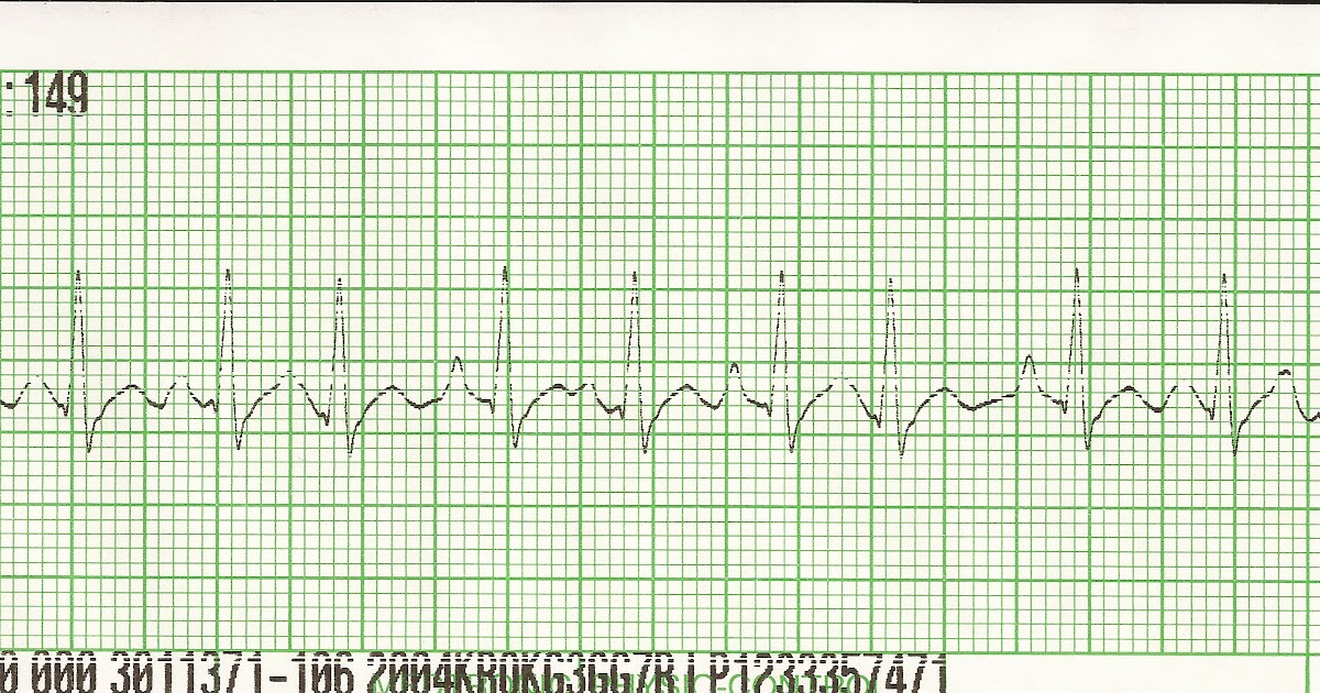 EKG Rhythm Strips 21: Fast rhythms