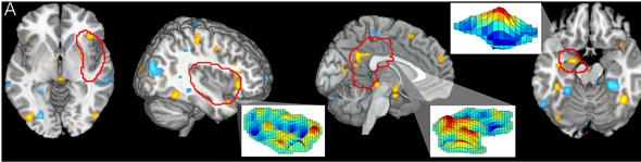 Neuroimaging Signature for Emotional Responses - Radiology Imaging