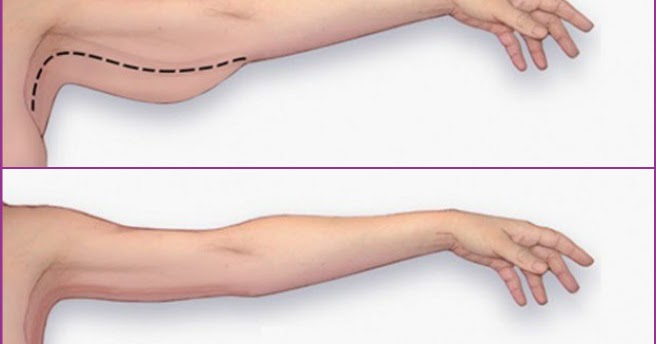 How To Get Rid Of Arm Fat - Handy DIY
