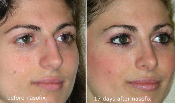 Reviews and Rants: Nasofix Review - Before and After Nasofix UPDATE