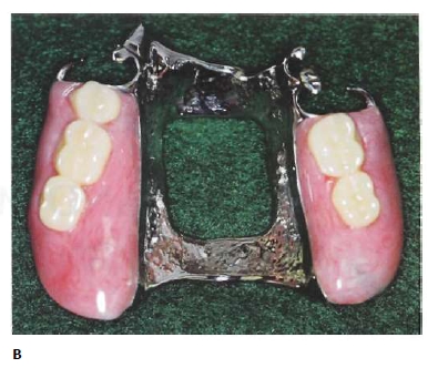 hiphoplife: Components of a removable partial denture